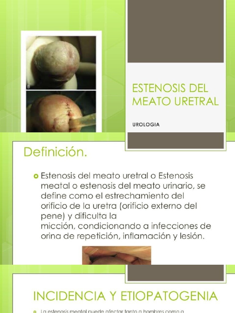 Estenosis Del Meato Uretral | PDF