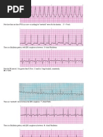 Pac PJC PVC | PDF | Cardiac Electrophysiology | Cardiac Arrhythmia