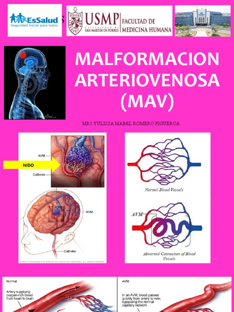 Malformación Arteriovenosa: Diagnóstico y Tratamiento | PDF | Cerebro ...