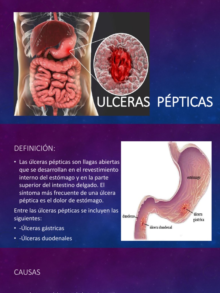 Ulceras Pépticas 1 | PDF | Enfermedades y trastornos | Drogas
