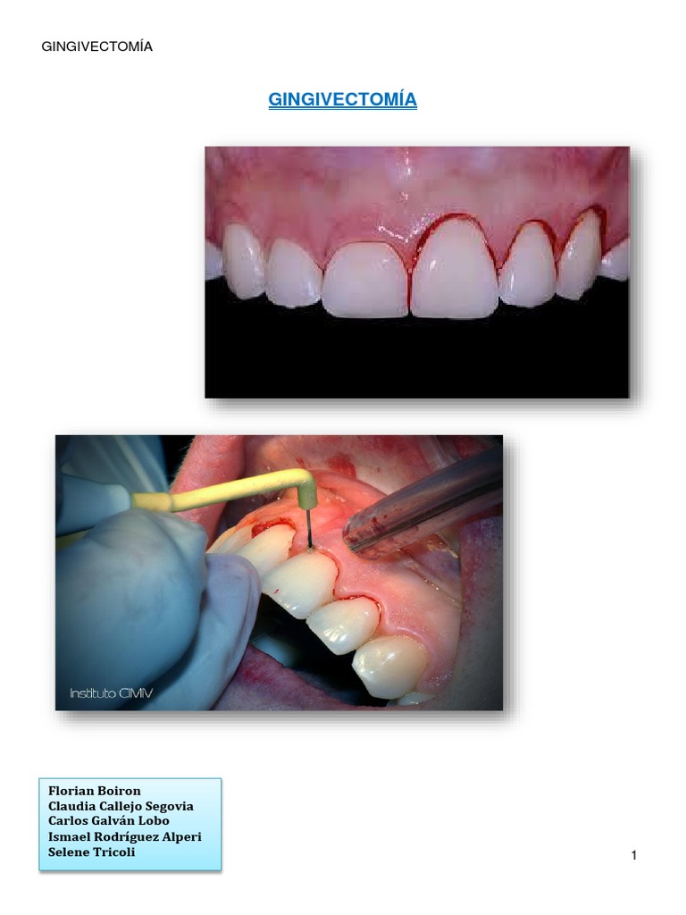 GINGIVECTOMÍA | PDF | Hepatitis | Boca
