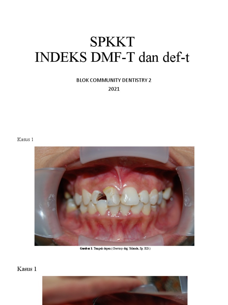 Kasus Untuk SPKKT Indeks DMFT-deft | PDF