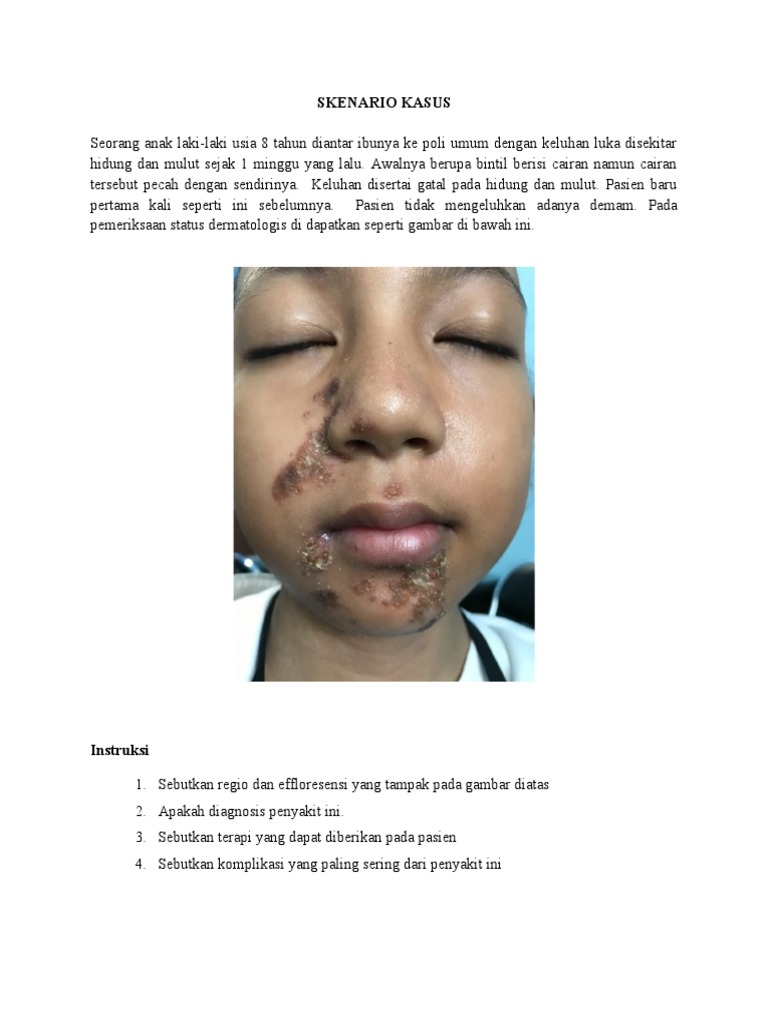 Impetigo Krustosa | PDF | Pengembangan Diri | Kesehatan Holistik