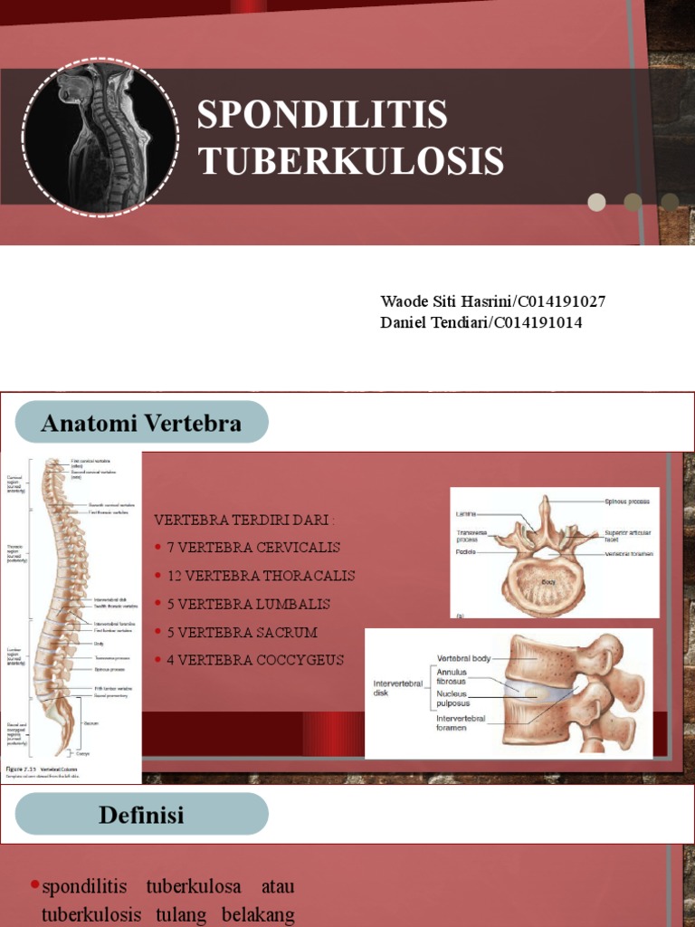 Spondilitis TB | PDF