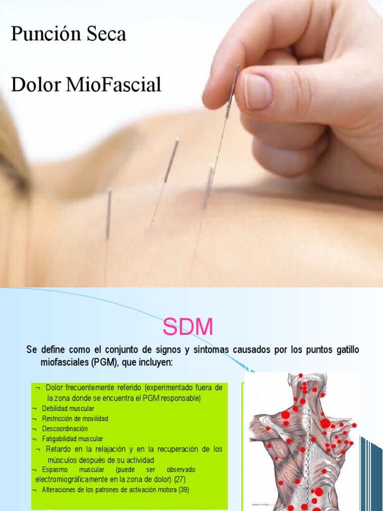 Punción Seca en el Tratamiento del Dolor | PDF | Punto gatillo ...