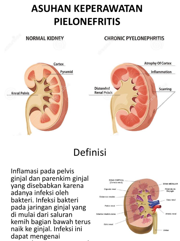 Asuhan Keperawatan Pielonefritis | PDF