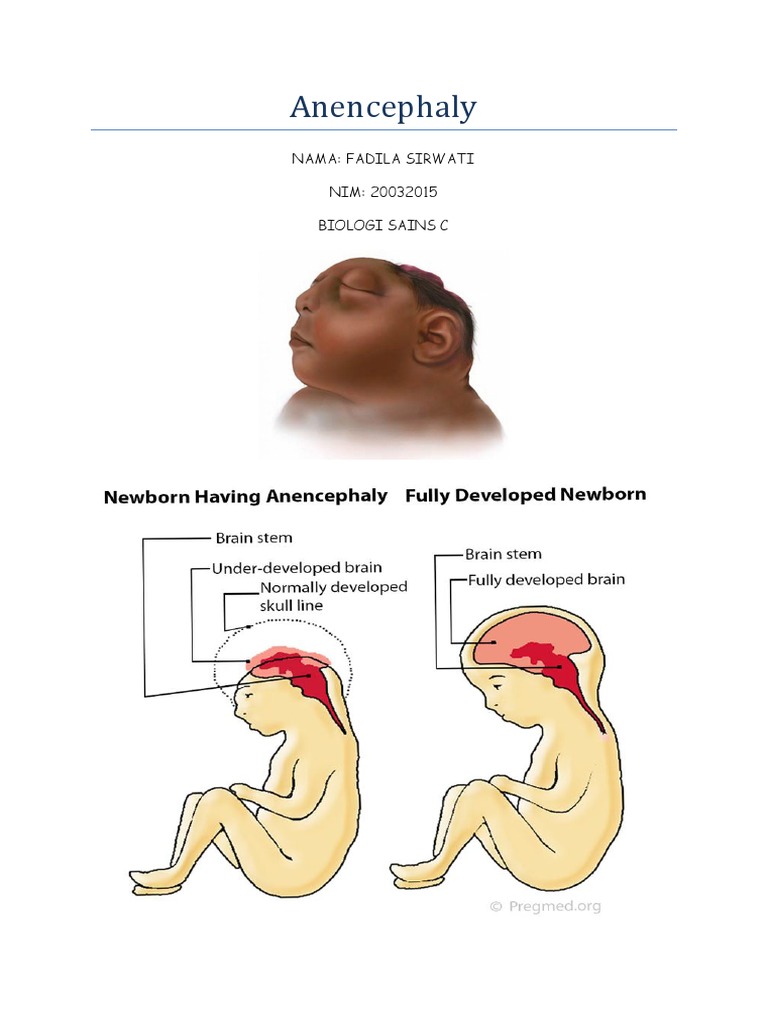 Anencephaly | PDF