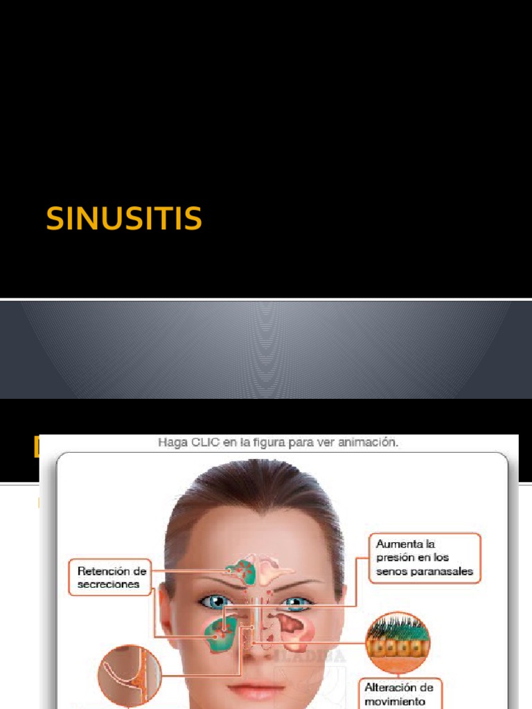 Sinusitis | PDF | Especialidades Medicas | Epidemiología