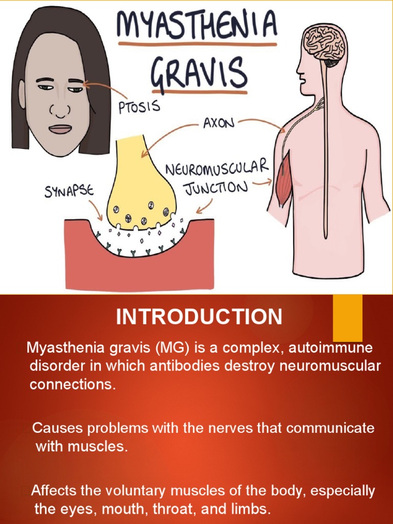 Pharmacotherapy Of Myasthenia Gravis PDF Electromyography Thymus