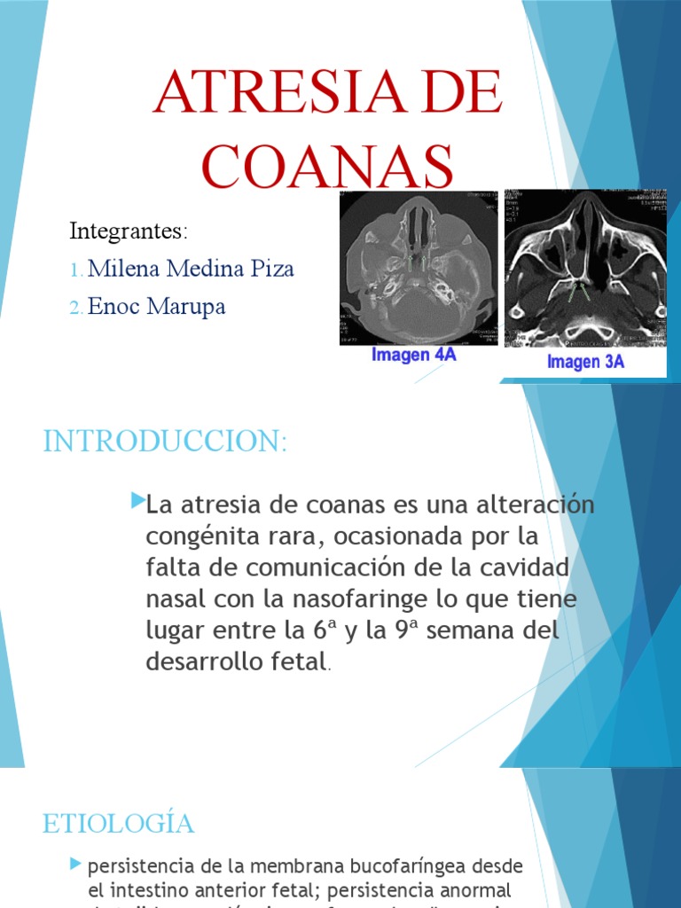 Atresia de Coanas | PDF
