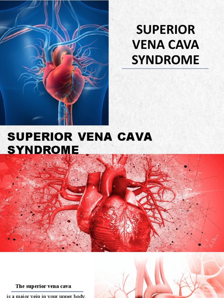 Superior Vena Cava Syndrome Flashcards – LHAHG
