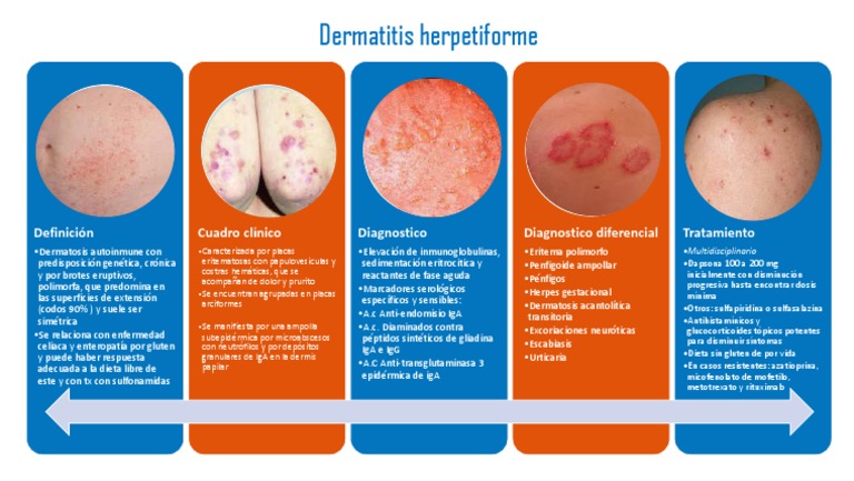 Dermatitis Herpetiforme | PDF | Ciencias de la Salud | Enfermedades y ...