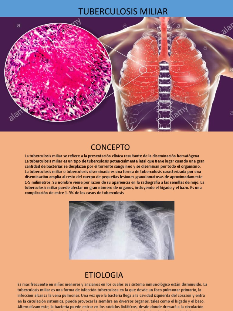 Tuberculosis Miliar | PDF | Especialidades Medicas | Medicina CLINICA