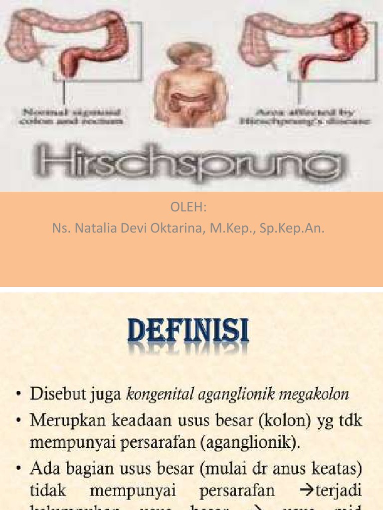 Hisprung Pada Anak | PDF