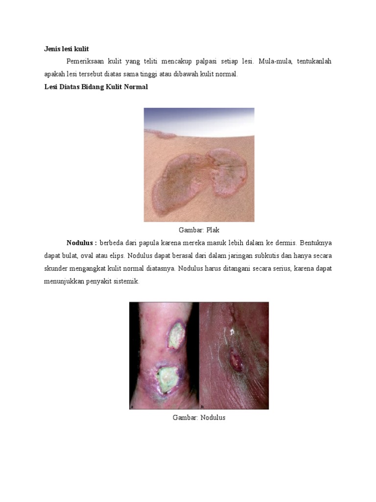 Jenis Lesi Kulit | PDF