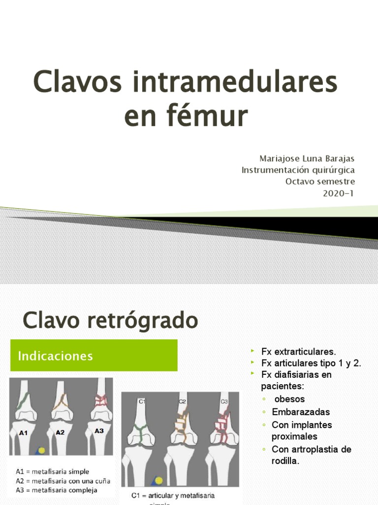 Clavos intramedulares en fémur: técnicas y tipos | PDF | Tornillo ...
