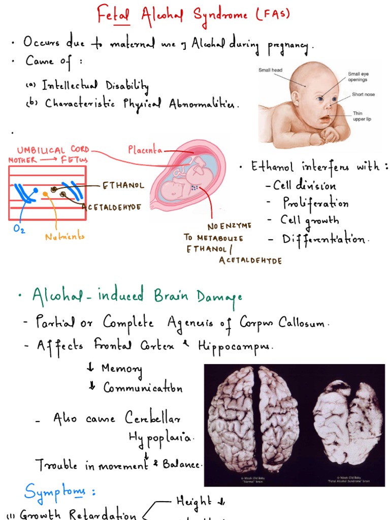 Fetal Alcohol Syndrome Pdf Health Sciences Medical Specialties