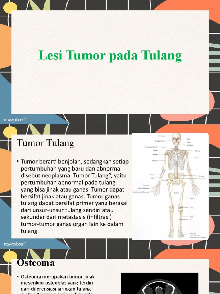 Lesi Tumor Pada Tulang | PDF