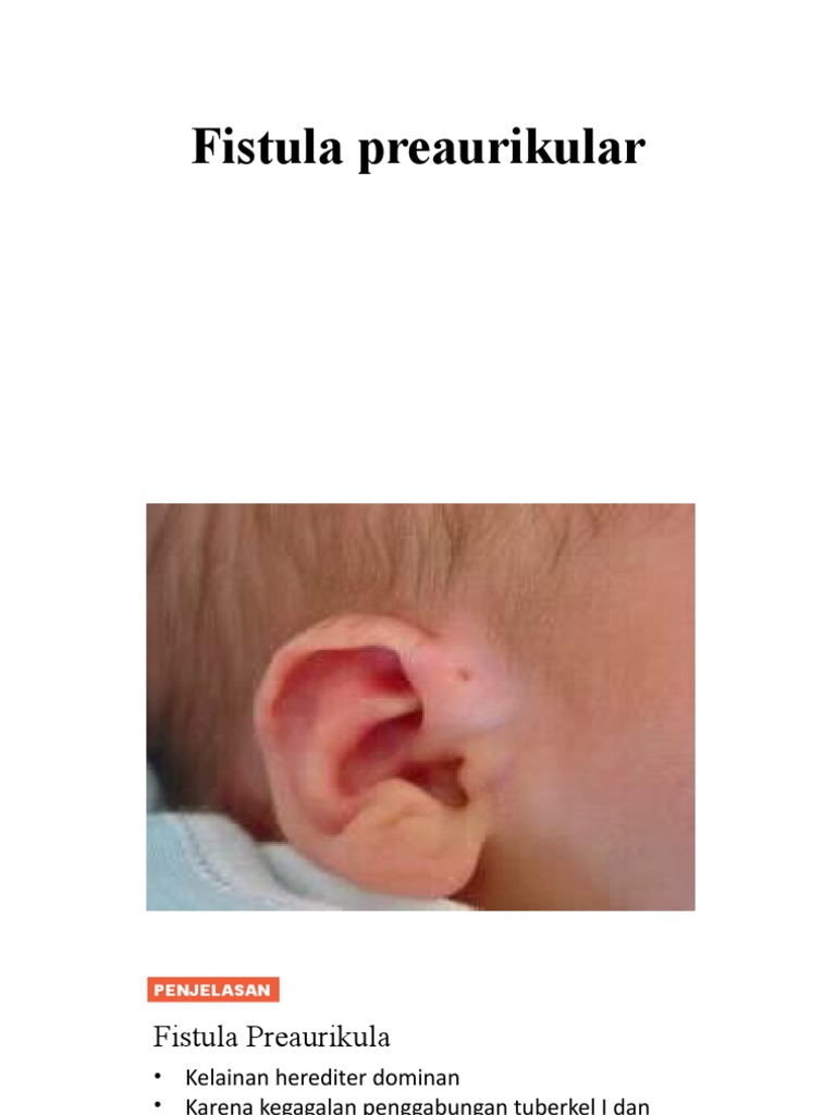 Fistula Preaurikular | PDF