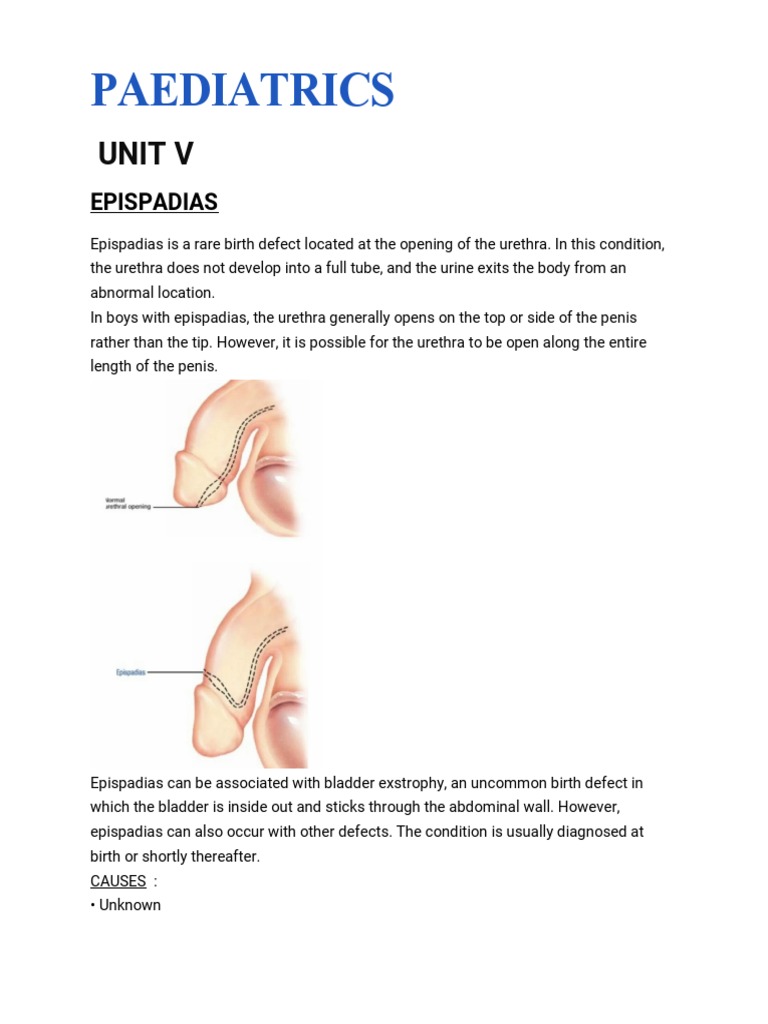 Epispadiasis (Paediatrics) | PDF