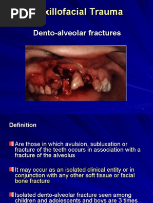 Alveolar Bone Fracture