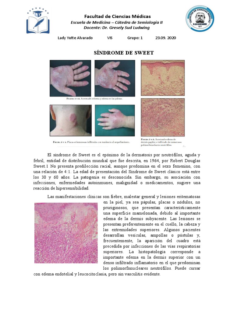 Causas y criterios del síndrome de Sweet | PDF | Cáncer ...