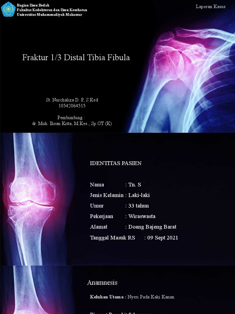 Laporan Kasus Fraktur 1,3 Distal Tibia Fibula - Amelia Astrid | PDF