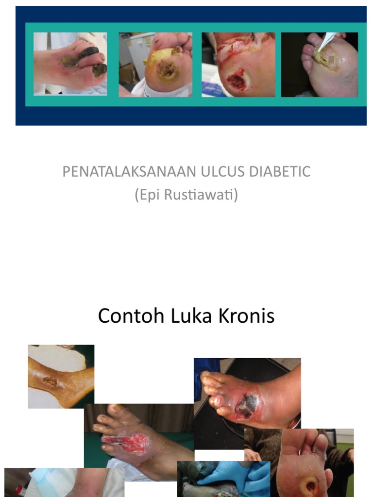 Ulcus Diabetikum | PDF | Seni | Kesehatan Holistik