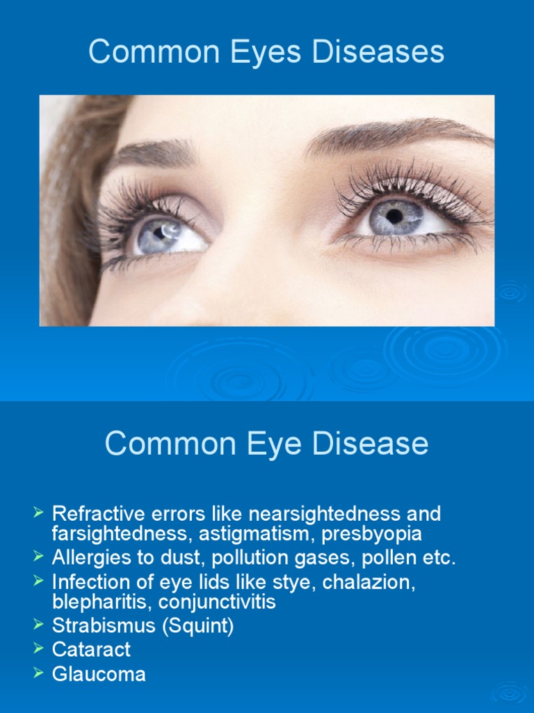 Common Eye Diseases | PDF | Glaucoma | Visual System