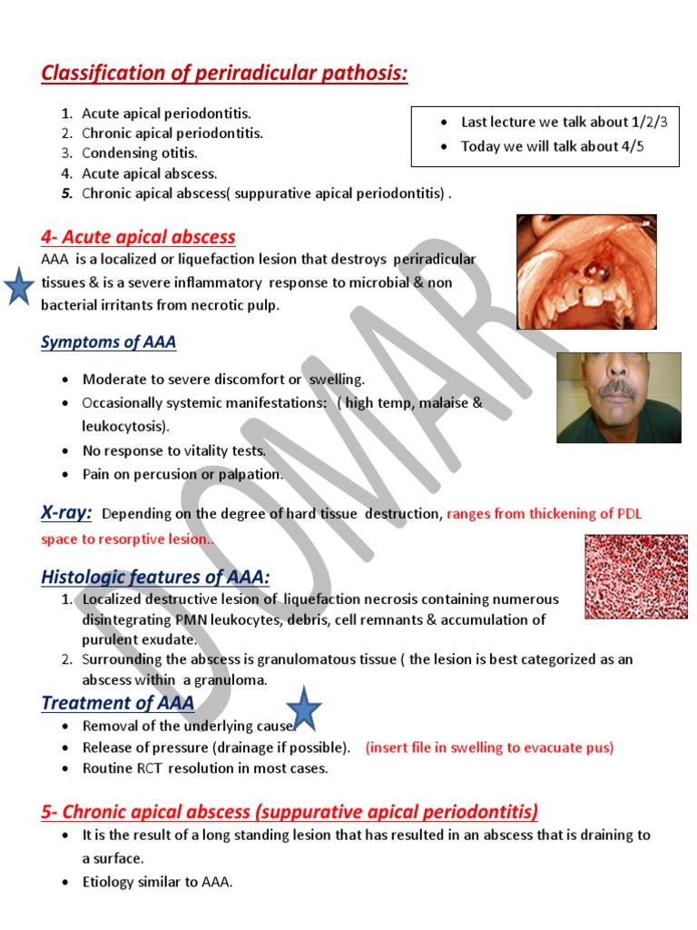 Classification of Periradicular Pathosis:: 4-Acute Apical Abscess | PDF ...