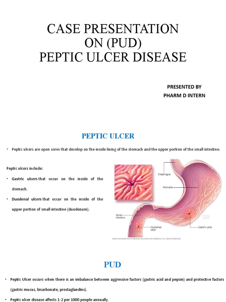 Case Presentation On (Pud) Peptic Ulcer Disease: Presented by Pharm D ...