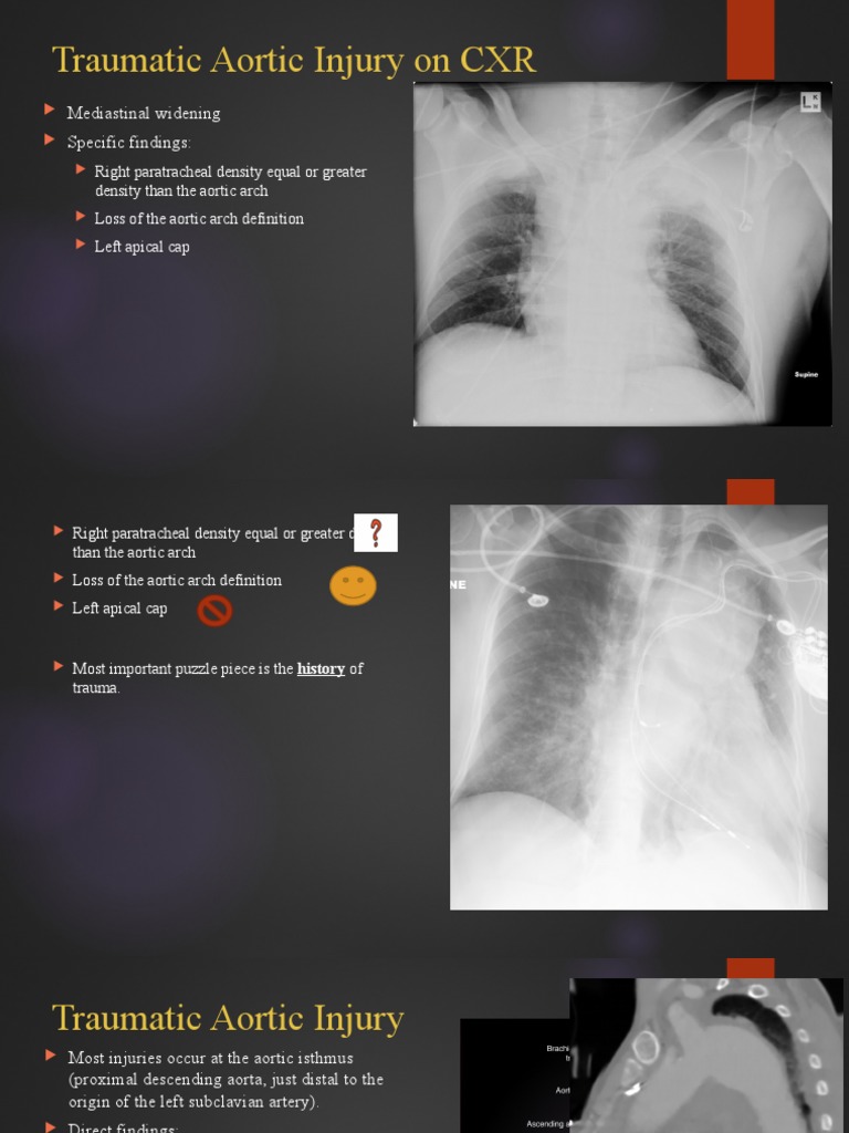 Traumatic Aortic Injury On CXR: Mediastinal Widening Specific Findings ...