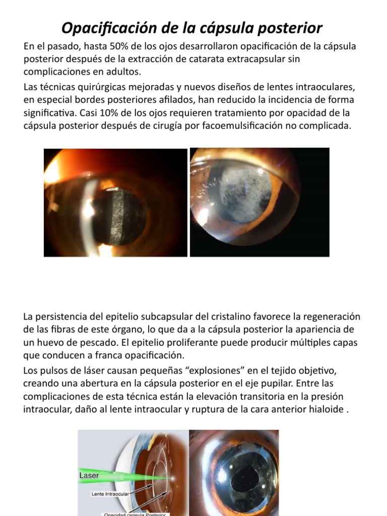 Reducción de la opacificación de la cápsula posterior mediante láser ...