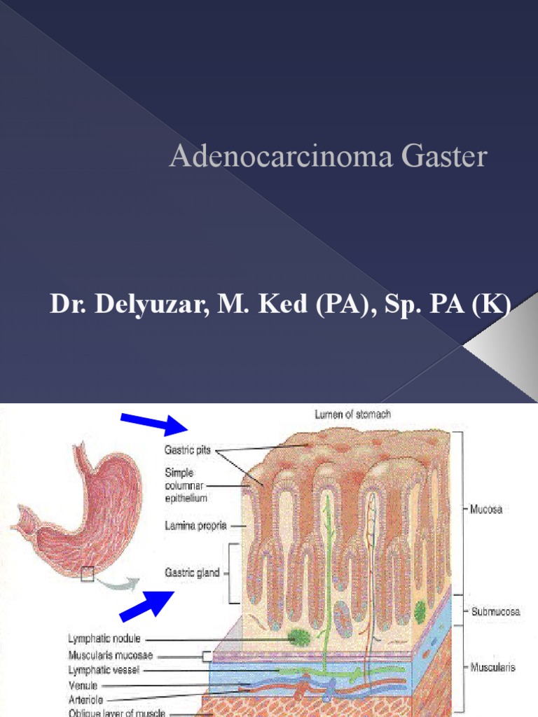 Adenocarcinoma Gaster: Dr. Delyuzar, M. Ked (PA), Sp. PA (K) | PDF ...