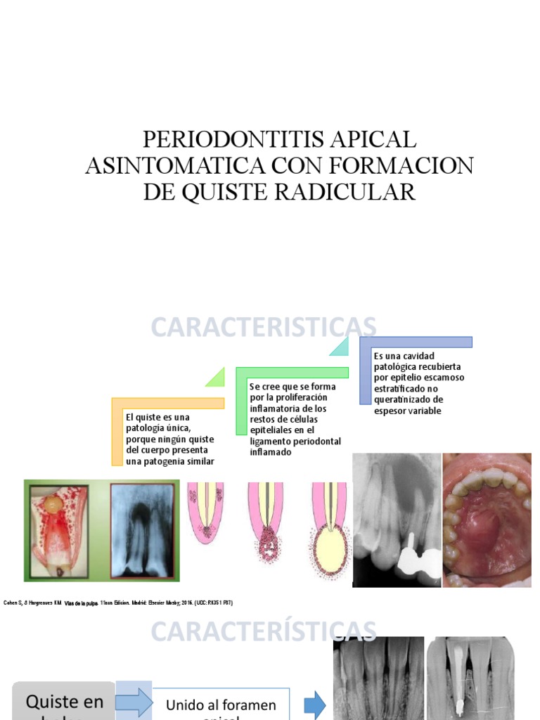 Periodontitis Apical Asintomatica Con Formacion de Quiste Radicular ...