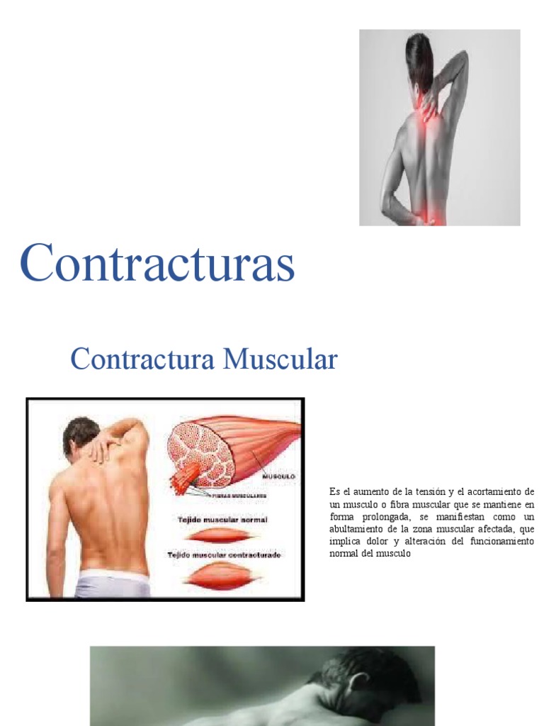 Contractura Muscular | PDF