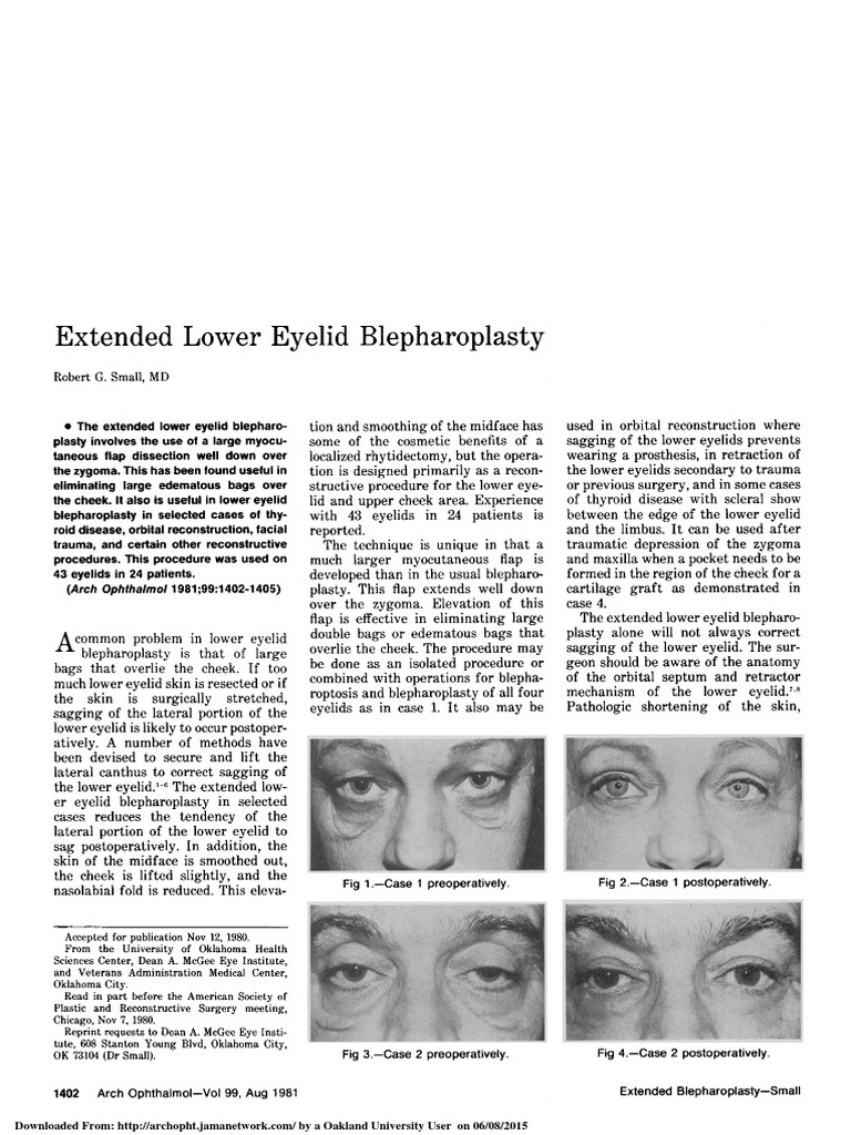 Eyelid Blepharoplasty: Extended | PDF | Clinical Medicine | Human Eye