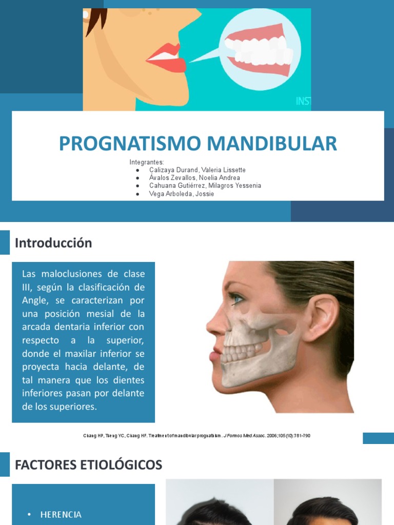 Prognatismo Mandibular | PDF | Ortodoncia | Ramas de Odontología