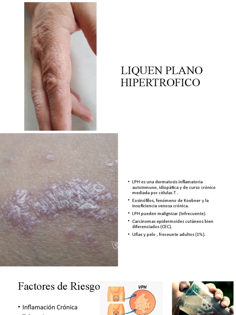 Liquen Plano Hipertrófico Diagnostico | PDF