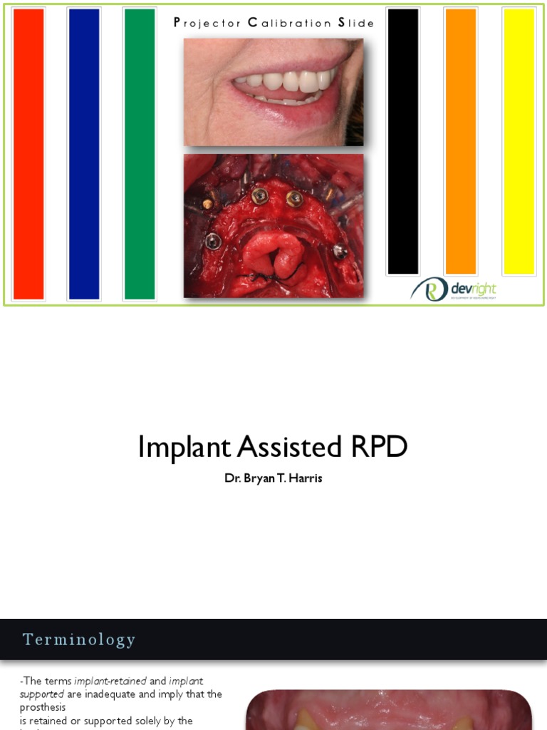 Implant Assisted RPD DMD 2016 | PDF | Dental Implant | Dentures