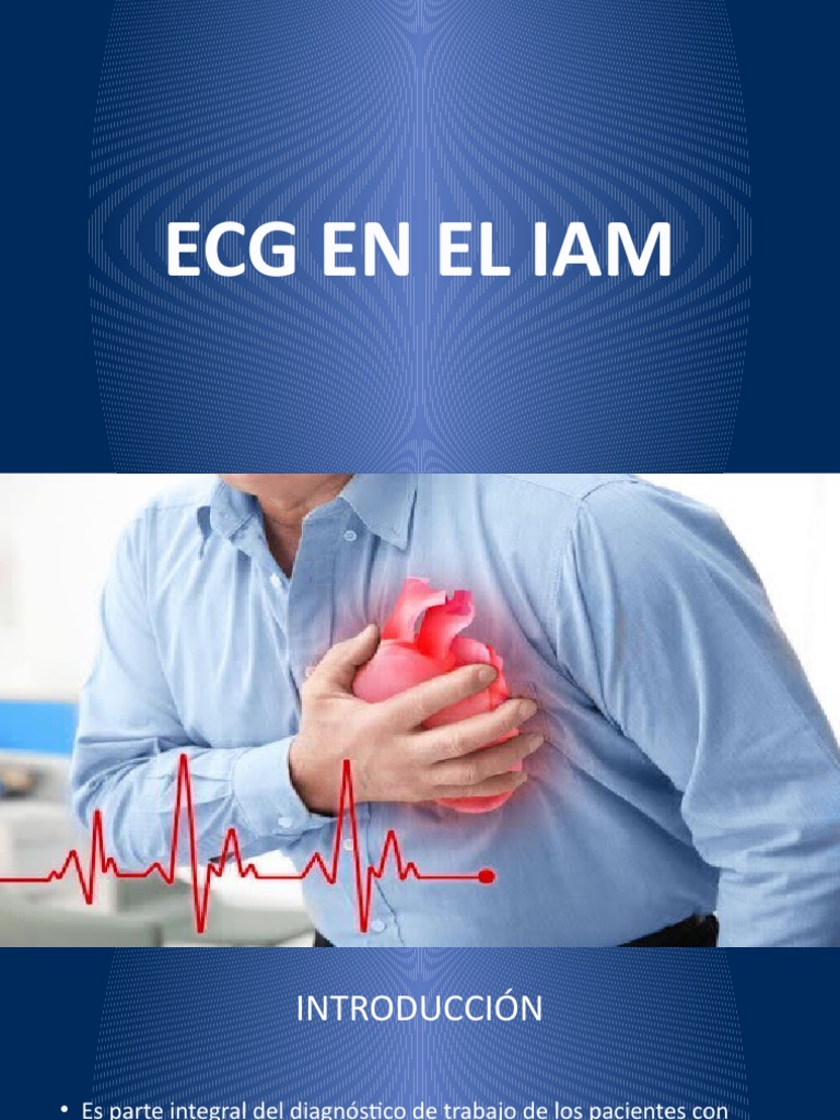 Ecg en El Iam | PDF | Electrocardiografia | Infarto de miocardio