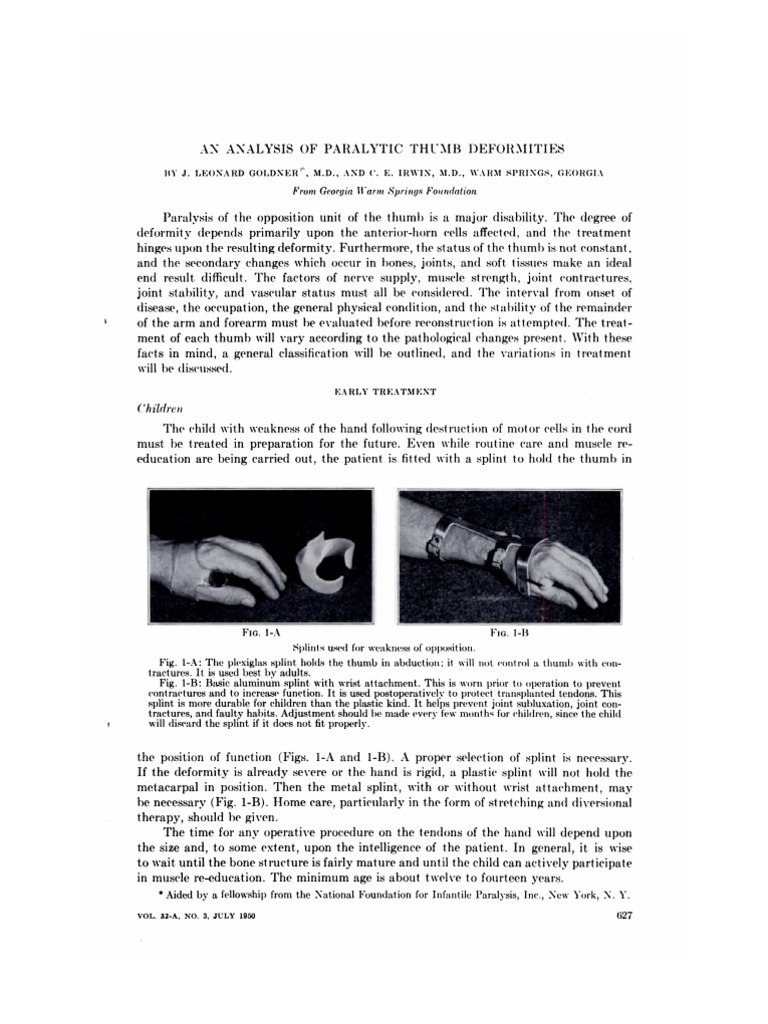 Ape Thumb Deformity Analysis and Treatment | PDF | Thumb | Finger