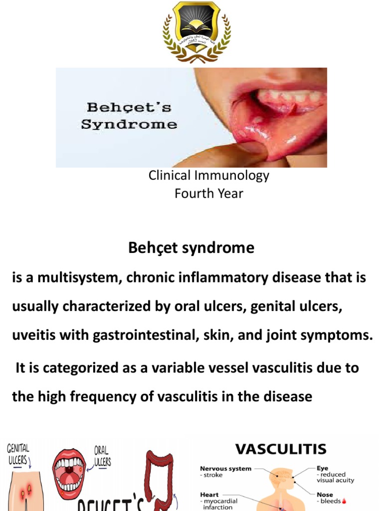 Behcet’S Syndrome Diagnosis – Maladie Behçet Espérance Vie – FJCY
