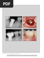 Straumann® Guided Surgery | PDF | Dental Implant | Surgery