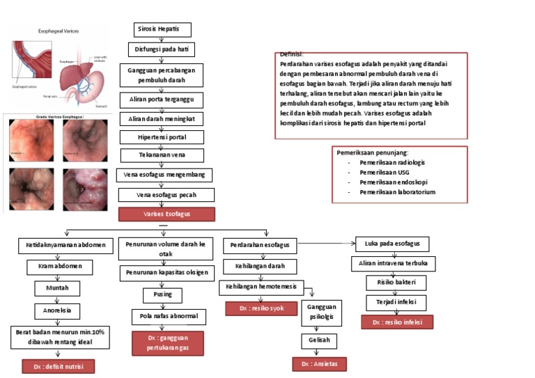 Varises Esofagus dan Komplikasinya | PDF