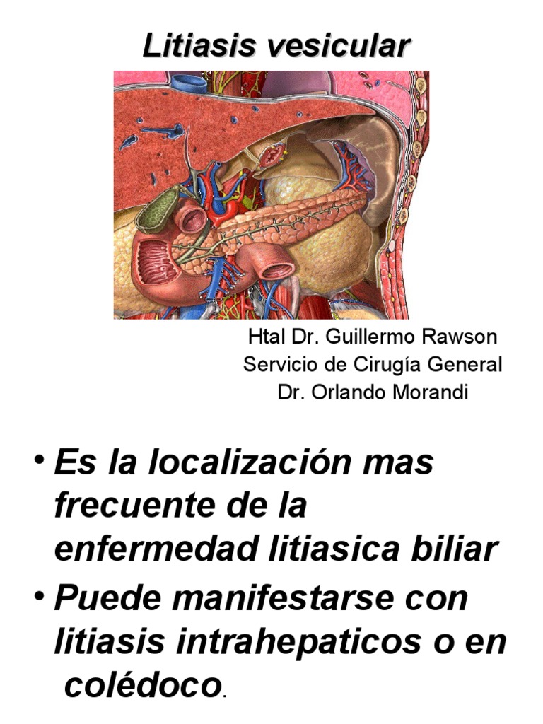 litiasis biliar