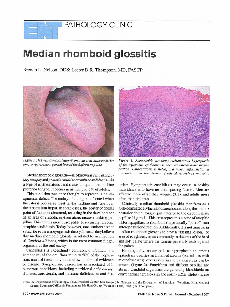 Median Rhomboid Glossitis: Brenda L. Nelson, DDS Lester D.R. Thompson ...