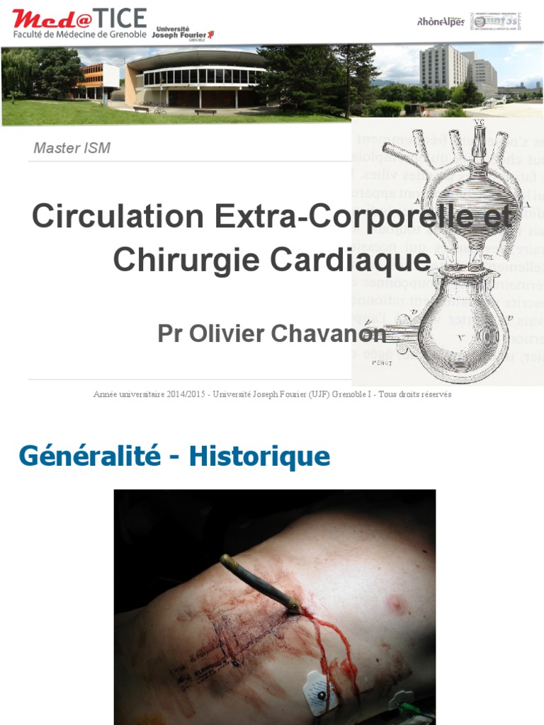 Circulation Extra-Corporelle Et Chirurgie Cardiaque | PDF | Cœur ...