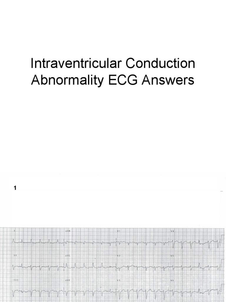 Intraventricular Conduction Abnormality Ecg Pdf Electrocardiography