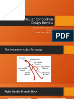 Left Anterior Fascicular Block (LAFB) - LITFL - ECG Library Diagnosis ...